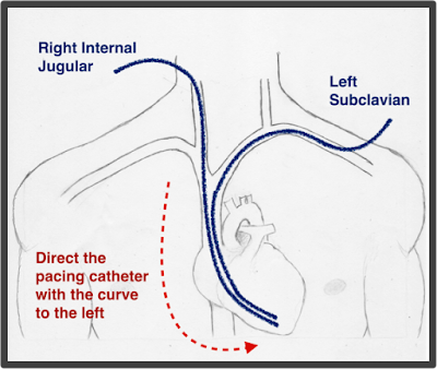Dr. Smith's ECG Blog: Emergency Transvenous Cardiac Pacing