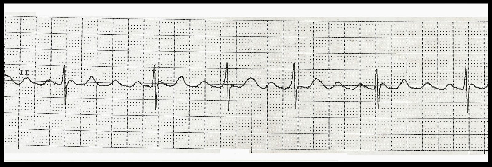 EKG Rhythm Strip Quiz 182