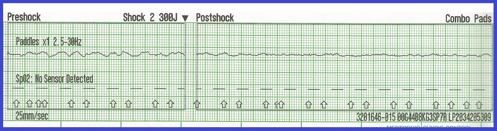 Code Blue: Sudden Cardiac Arrest