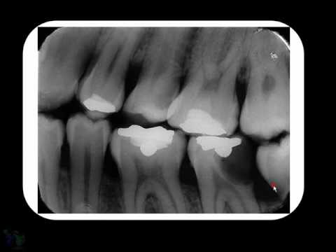 radiología en odontología : RADIOGRAFÍAS DENTALES