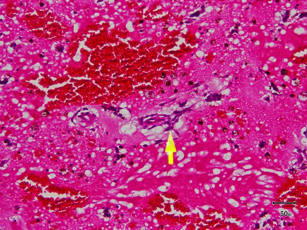 Left atrial myxoma in a child: an uncommon presentation of a rare tumor ...