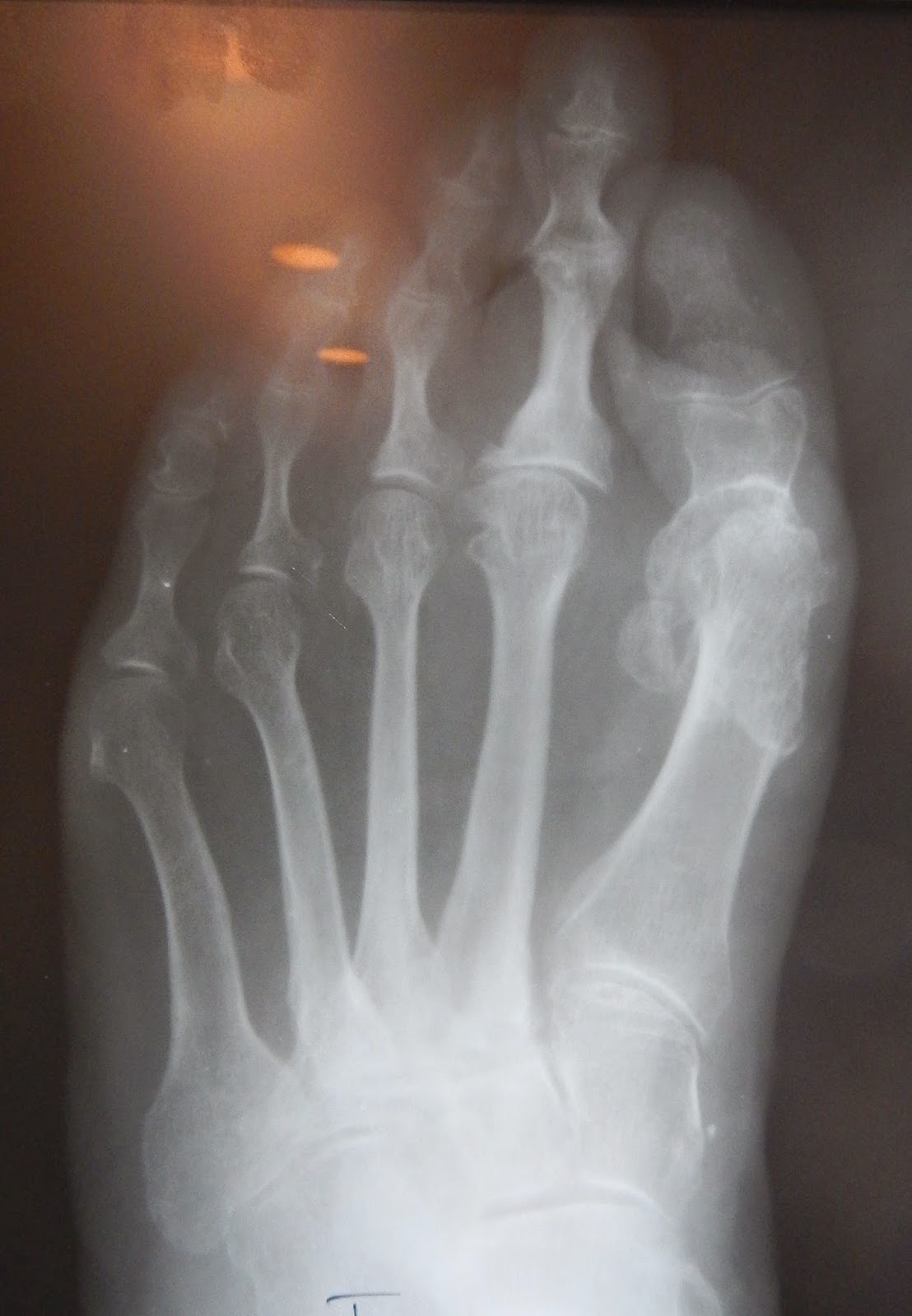 Podo Basas al Día: Hallux extensus iatrogénico y dedos. Otro desastre ...