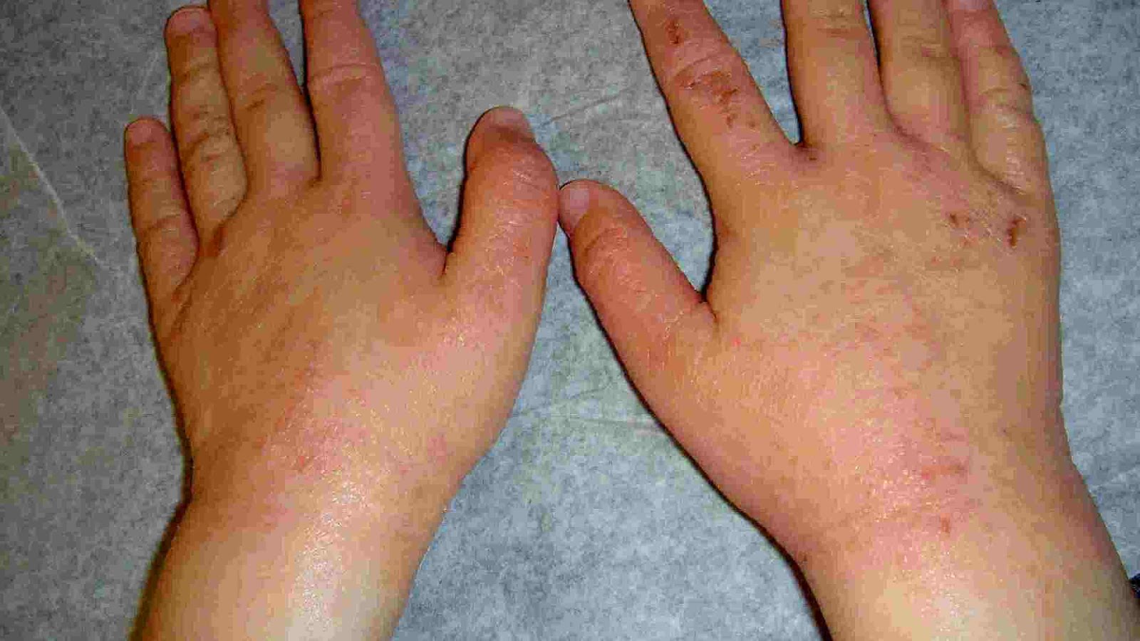 Ulcerative Colitis Skin Rash - Ulcer Choices