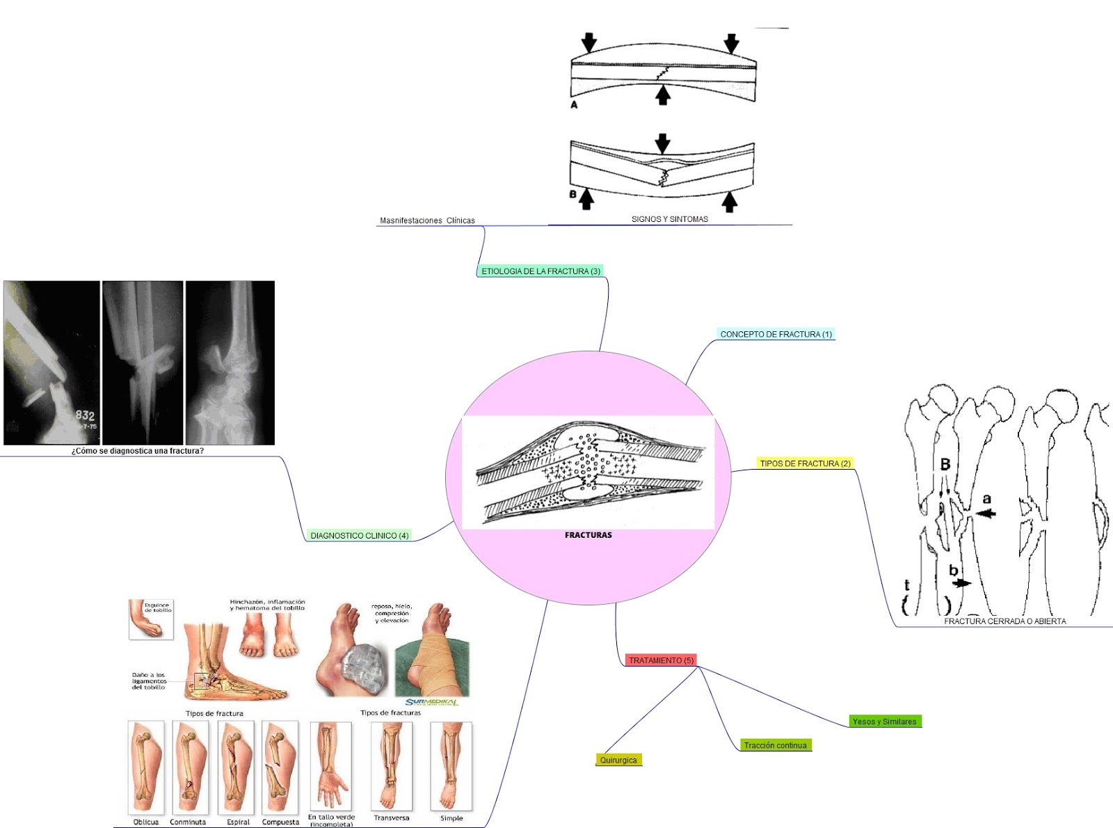 FRACTURAS | MI VIDA EN ENFERMERIA
