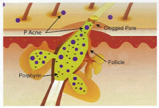 DermaSphere: Adult Acne: Myth Or Reality? (Part I)