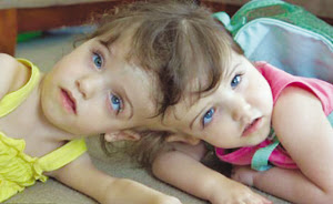 craniopagus conjoined twins pictures |Daily Pictures