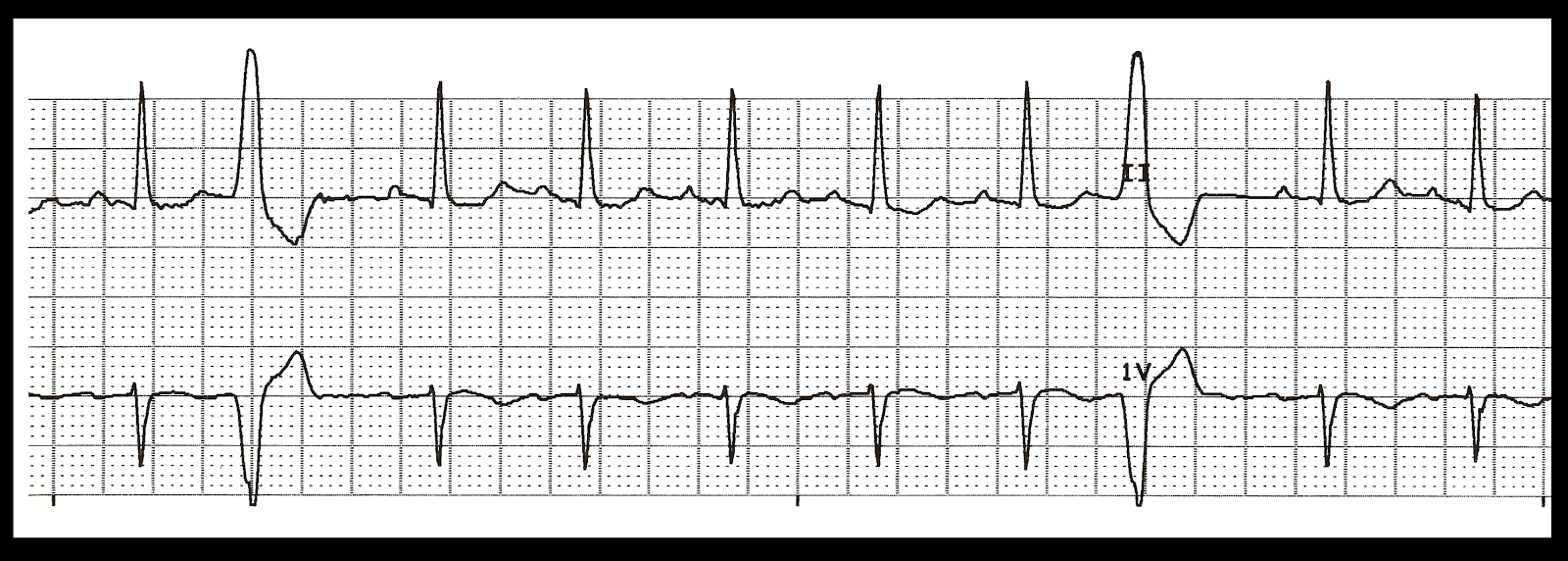 EKG Rhythm Quiz 275