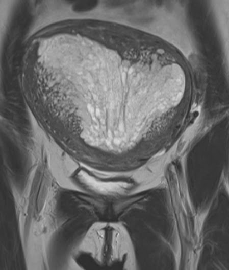 mricases: Endometrial Hyperplasia - MRI