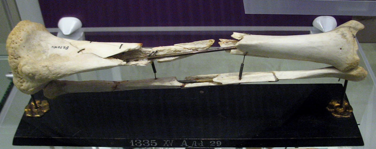 Landmarks: General Sickles' Leg