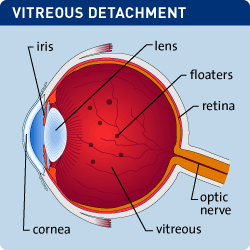 Eye 2 Eye Optometrists: Eye Floaters (Benign)