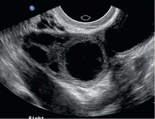 Health Check; Ovarian Cysts