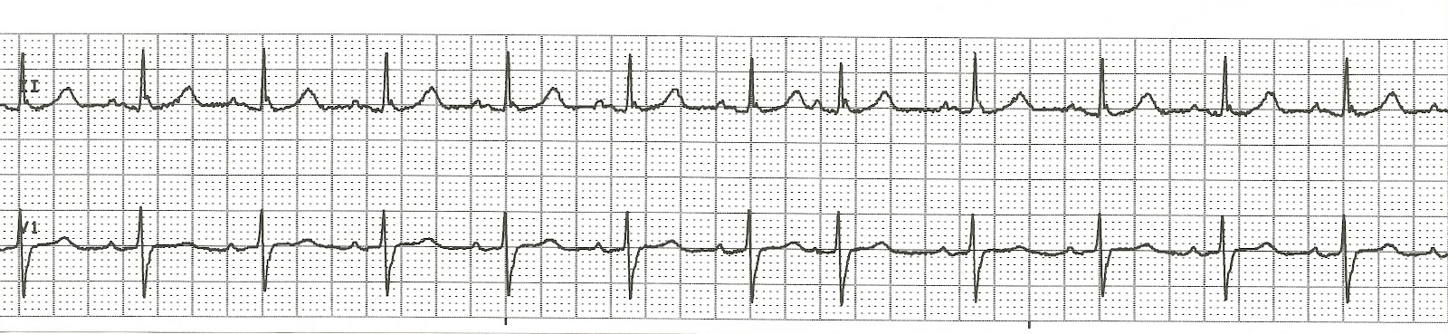 Float Nurse: Practice ECG Rhythm Strips 92