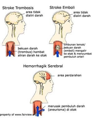 Healthy Life: STROKE