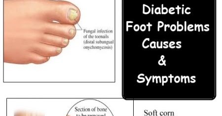 Health Information Guide- HELP: How Diabetes Causes Foot Problems