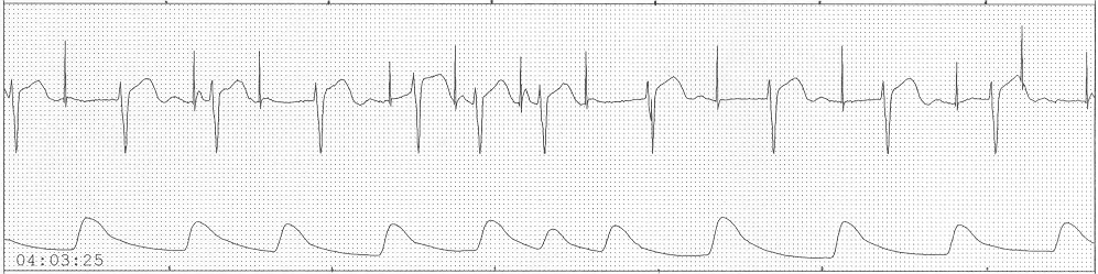 Pedi cardiology: ICU: Permanent Pacemaker