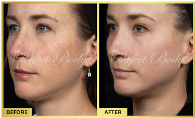 Perfect Body Laser and Aesthetics