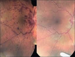 Medical Treatment Pictures-for Better Understanding: Retinal Laser ...