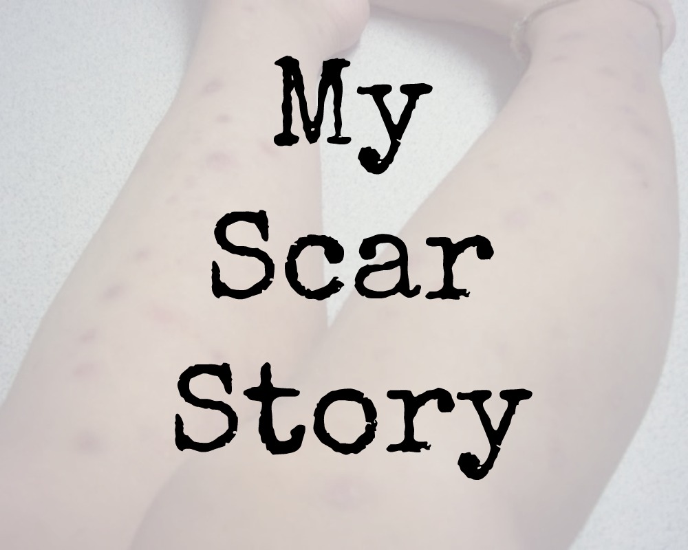My Scar Story - Whimsical Mumblings