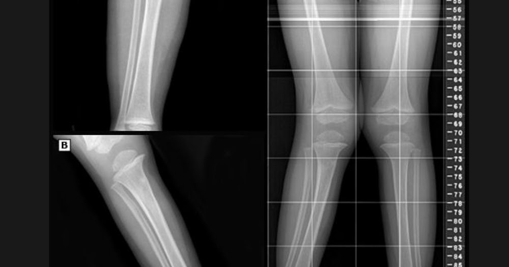 ¿Que es el Fenómeno de Cozen?