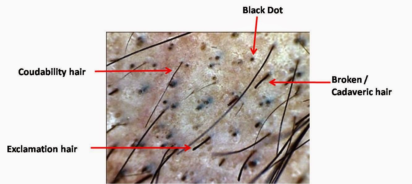 Teledermatology for PG entrance: Alopecia Areata