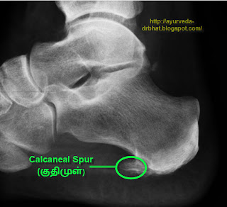 AYURVEDA: Calcaneal Spur (குதிமுள்) - ஆயுர்வேதத்தில் இதற்கு தீர்வு உண்டா?