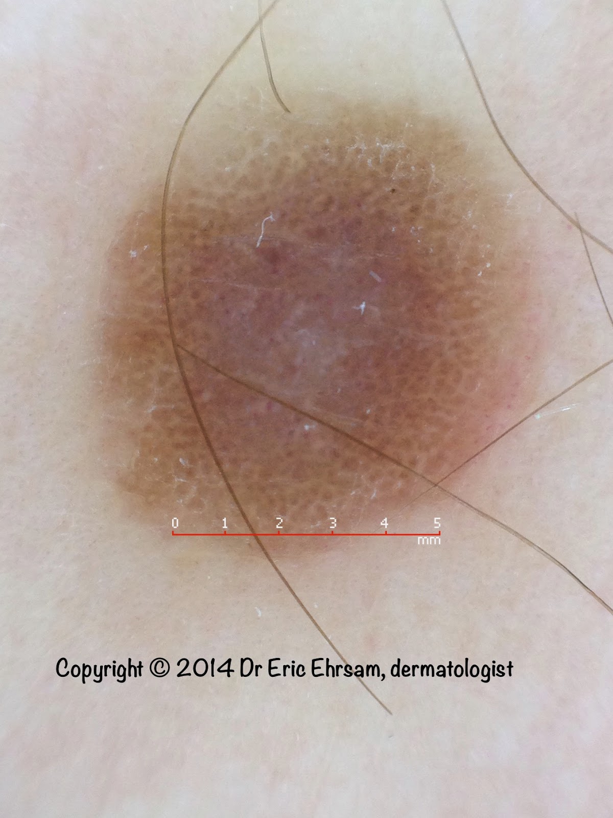 dermoscopy: March 2014