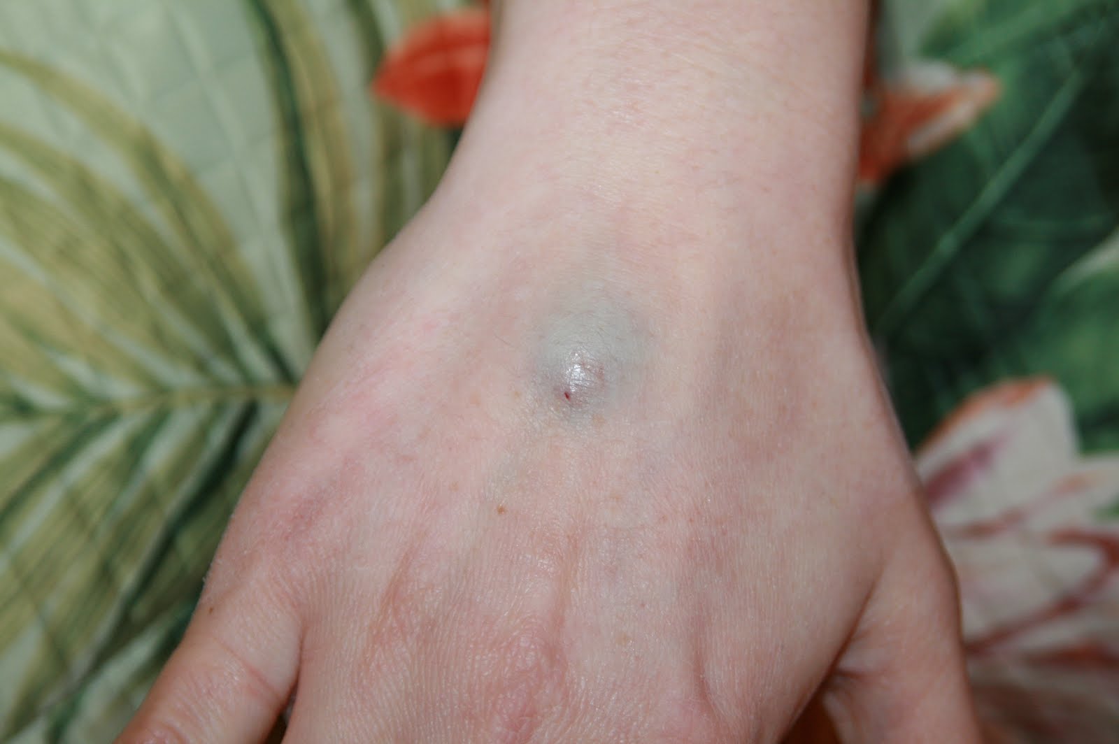 CCSVI Change 4 MS: Day Three: Recovery Day