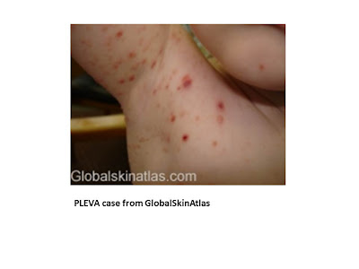 Consultations in Dermatology: Pityriasis Lichenoides PLEVA