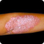 Recovery Corner: Today is World Psoriasis Day