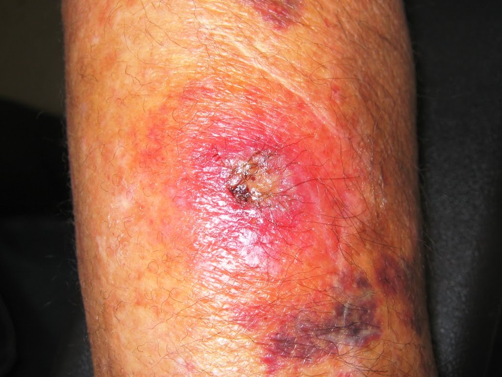 HEALTH FROM TRUSTED SOURCES: MRSA Infections of the Skin