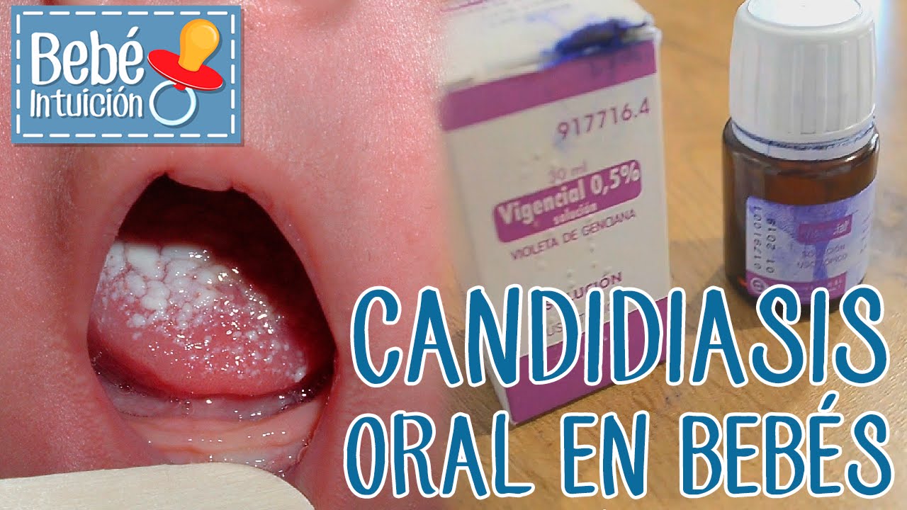 Enfermería Infantil: Candidiasis bucal en niños
