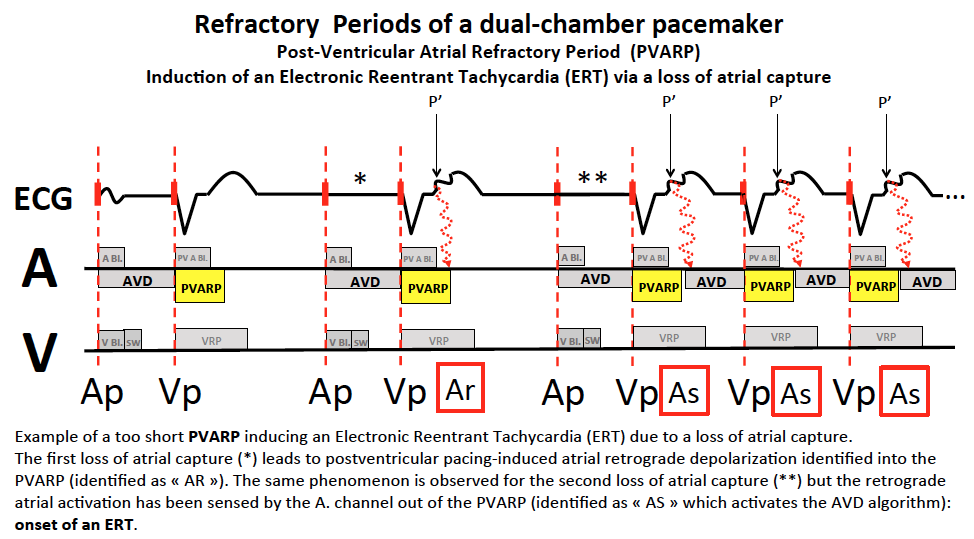 Dr Han Naung @ Henry Han : Electrophysiology and Heart Rhythm : AV ...