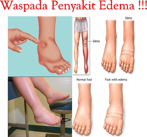 Obat Tradisional Penyakit Edema ~ Obat Alami Tradisional