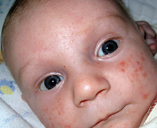 Baby Pimples | Infant and Babies Acne: Pimples on baby's face Cure