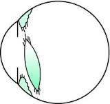 Anterior Segment Damage In Contusion Eye Injury : Sight Medical Blog