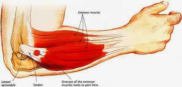 Case of the Week 3-19-14: Chronic "Elbow" Pain | Modern Manual Therapy ...