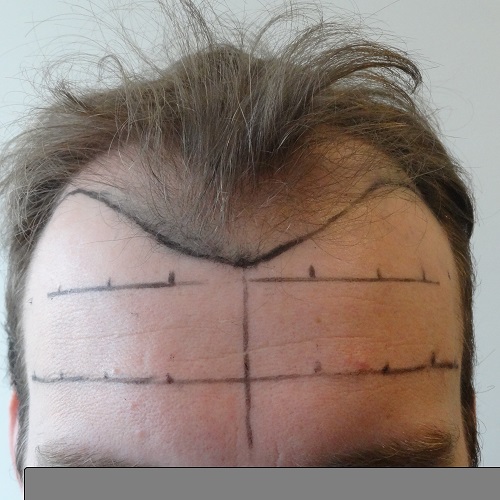 101 : Hairline design (it is not a 5 minute job)