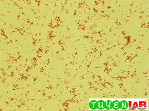 Amorphous Urates In Urine