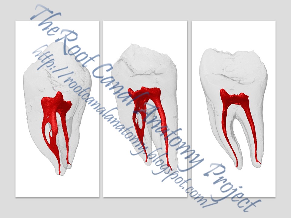 Root Canal Maxillary First Molar Anatomy