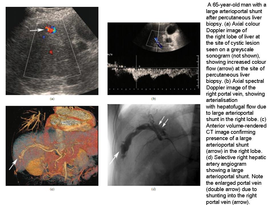 BÀI SOẠN VỀ SIÊU ÂM CHẨN ĐOÁN: Hepatic Vascular Shunts