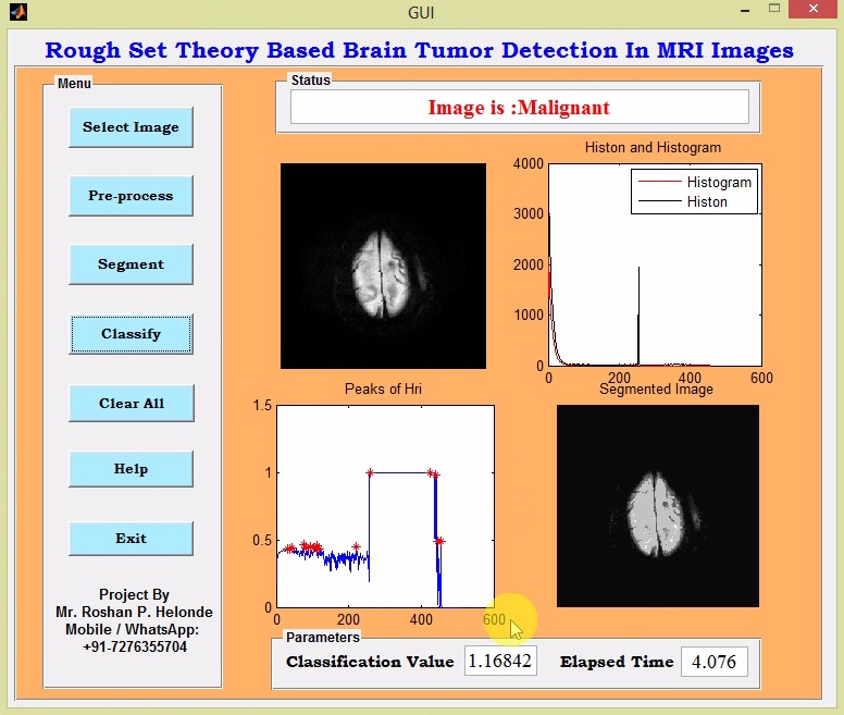 Matlab Project with Source Code Rough Set Theory Based Brain Tumor ...