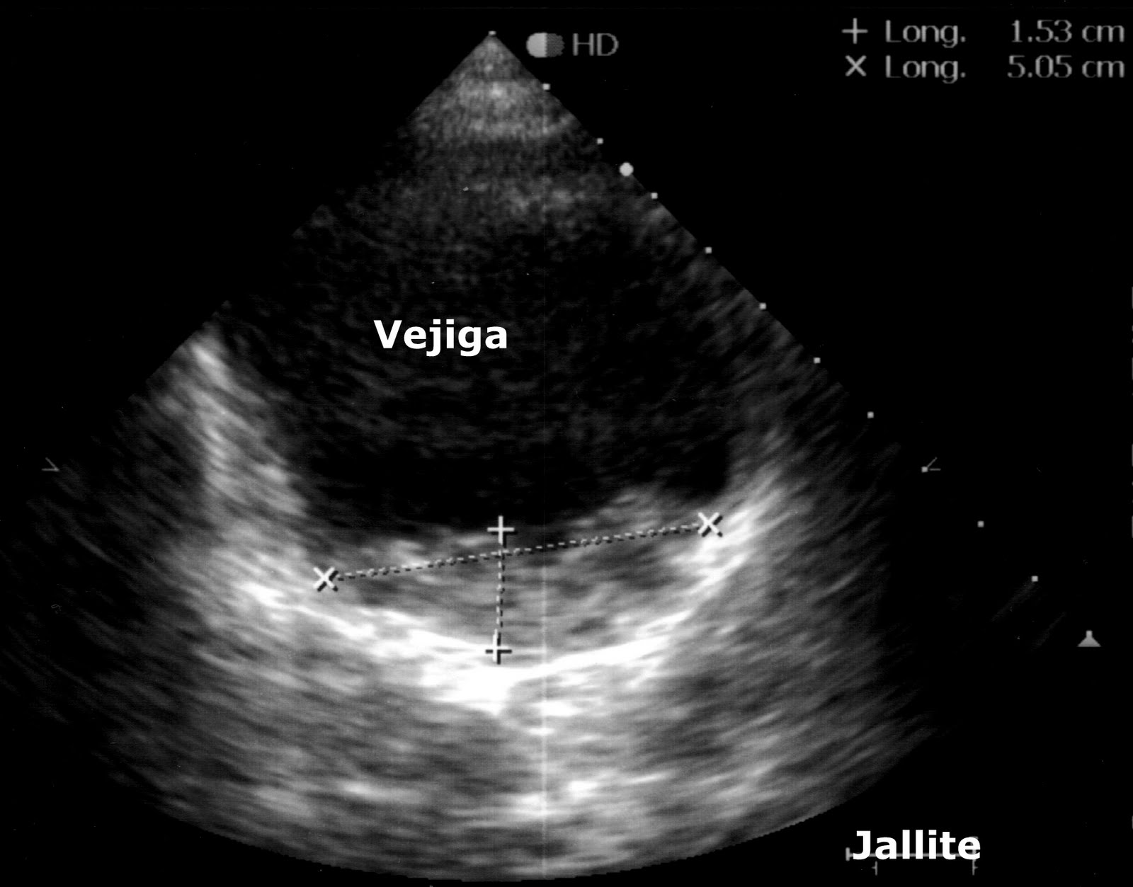 Cistitis Intersticial