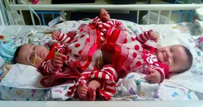zack: Conjoined Twins Who Were Attached at Pelvis Are Successfully ...