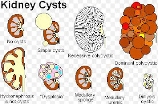 treatment for kidney disease: Different Types of Kidney Cyst