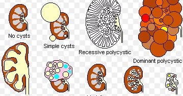 treatment for kidney disease: Different Types of Kidney Cyst