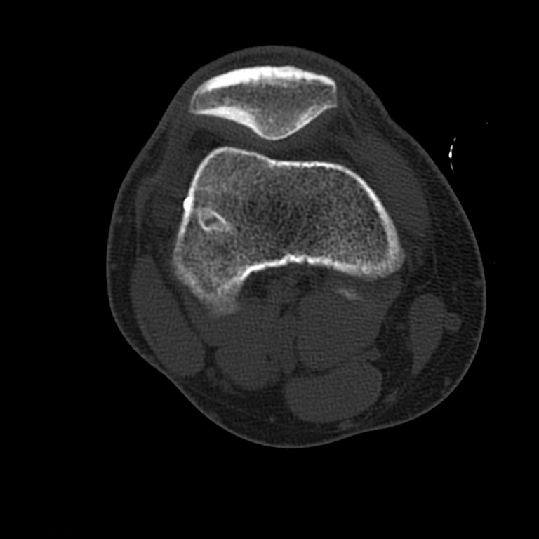 CT Knee - Radiology Imaging
