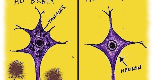 The role of plaques and tangles in Alzheimer's Disease