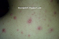 Wazzup Dok ?: Bulutong Tubig , Chicken Pox or Varicella Zoster