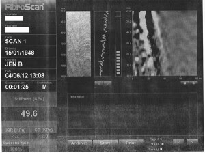 FibroScan® Understanding The Results