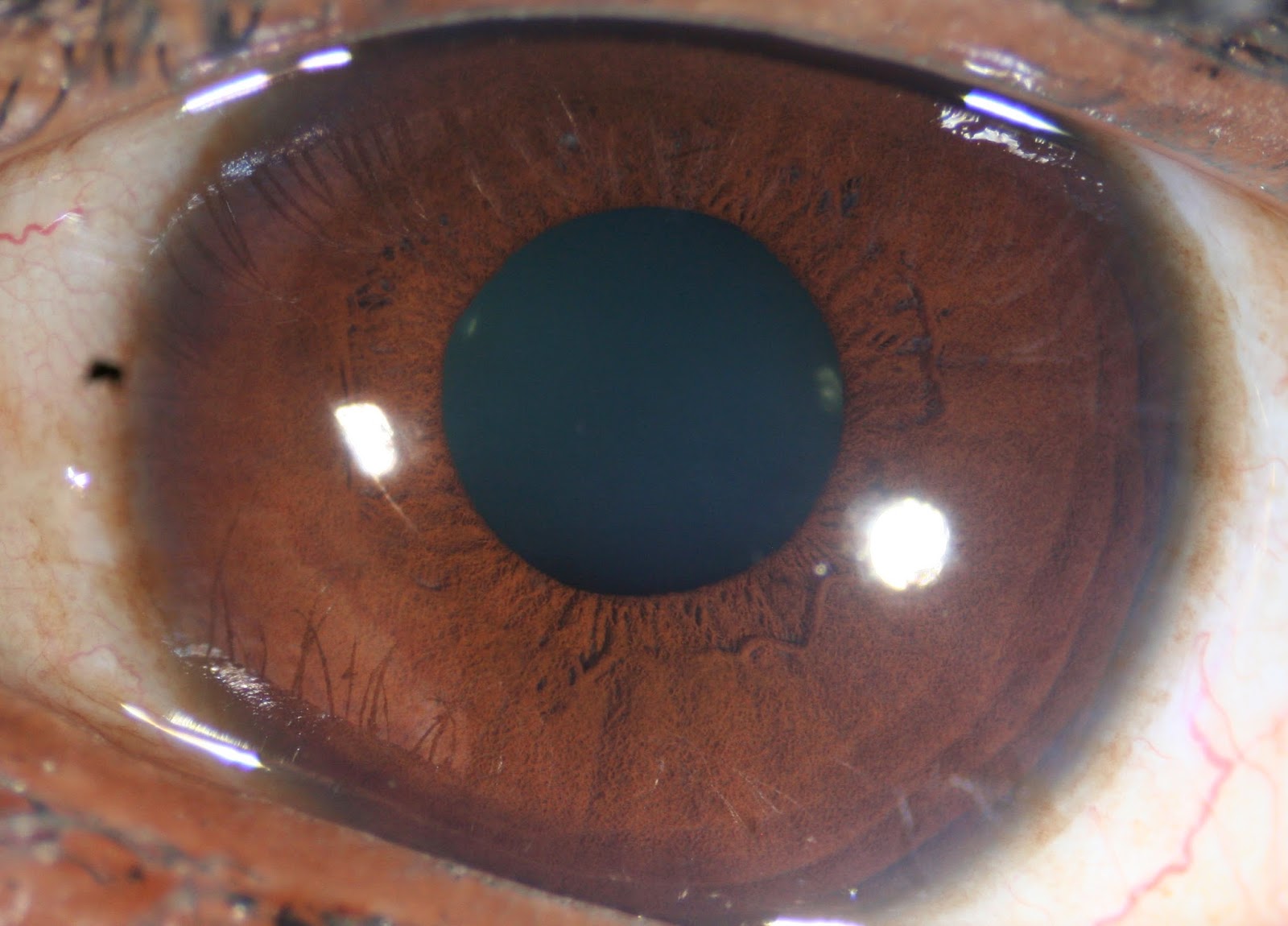 Modern & Multidimensional Iridology: Atrophy IPB, Pupil Flattenings ...